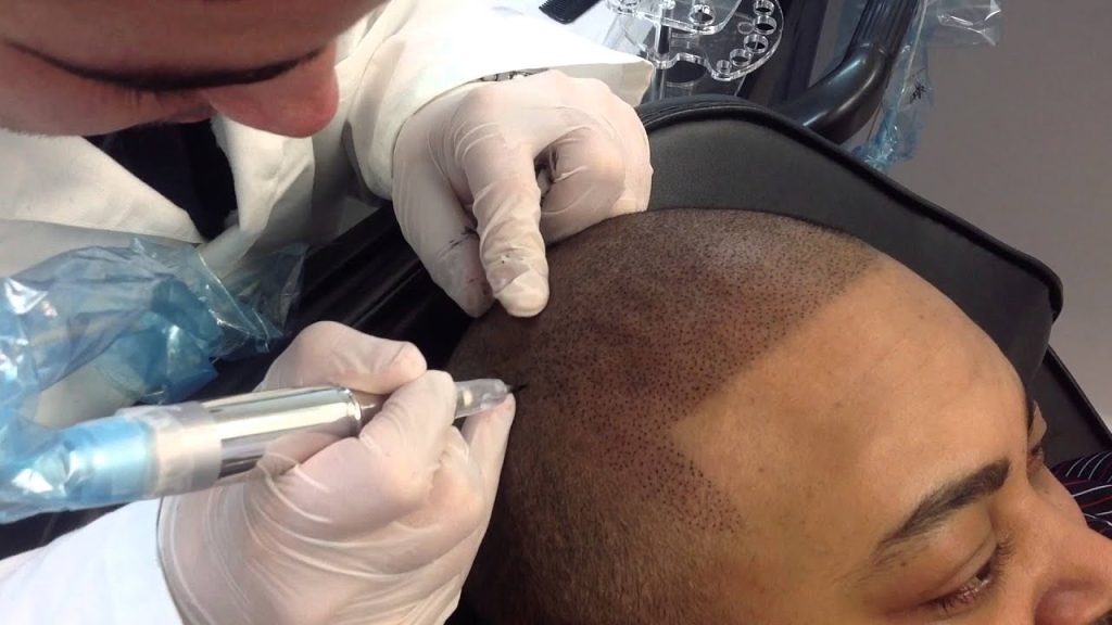 WHY SCALP MICROPIGMENTATION IS THE NEW POWER MOVE FOR HAIR LOSS? - Lips ...